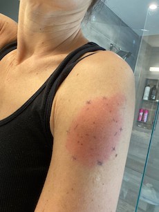MGH Researchers Call For Greater Awareness Of Delayed Skin Reactions MGH Researchers Call For Greater Awareness Of Delayed Skin Reactions